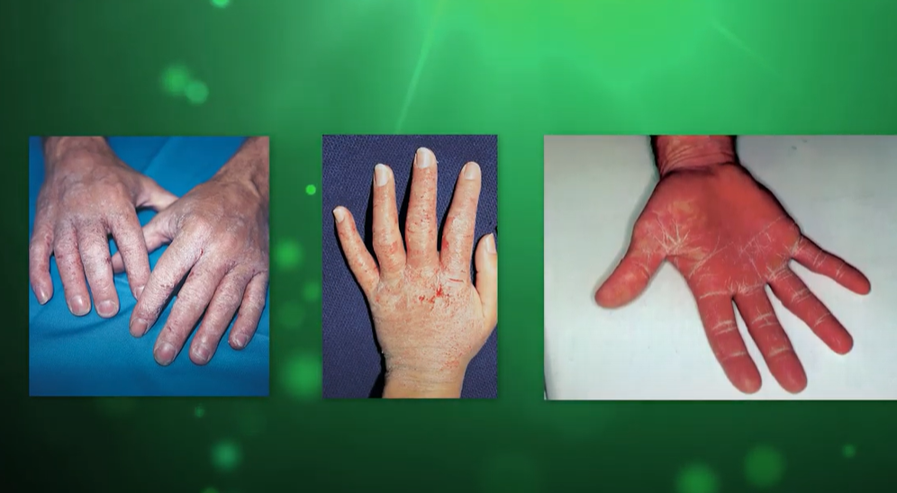 Nitrile Glove Allergy (Choosing the right One) - Gloveszone
